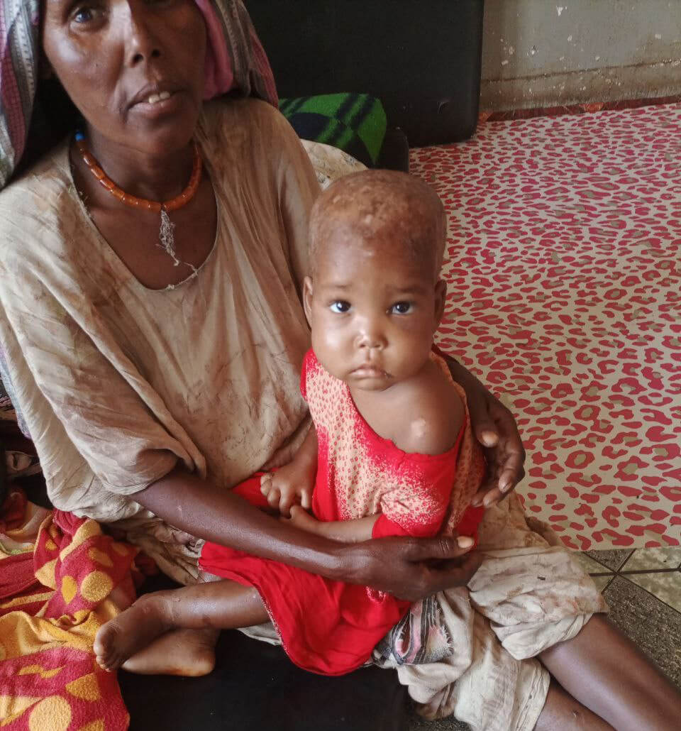 Kubra Receives Lifesaving Nutrition Treatment in Ethiopia ...